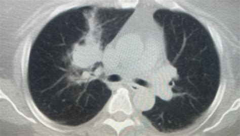 Pleural And Parenchymal Blood Patching Techniques In Lung Biopsy Backtable