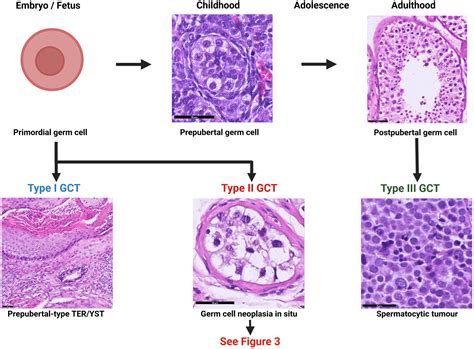 Pathogenesis And Pathobiology Of Testicular Germ Cell Tumours A View
