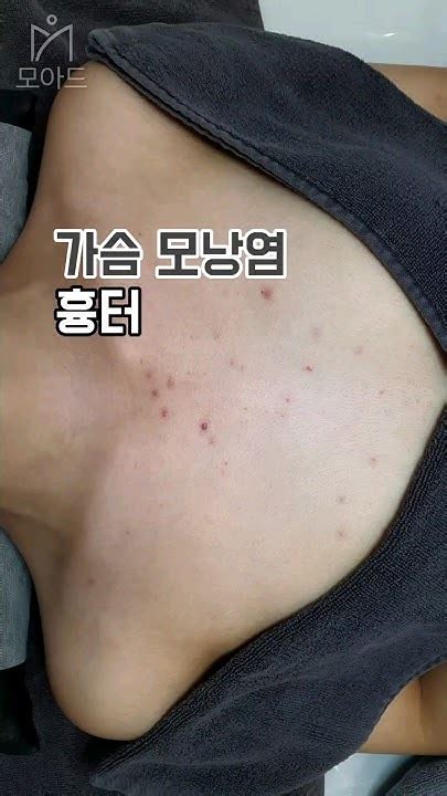 가드름 가슴 모낭염 흉터 건대 피부관리 모아드 Youtube
