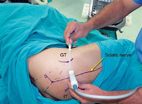 Ultrasound Guided Sciatic Nerve Block Posterior Approach Semantic
