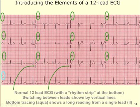 Normal 12 Lead Ecg Labeled