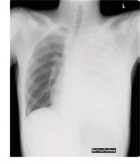 Figure 1 From Massive Hematothorax After Thoracic Spinal Manipulation
