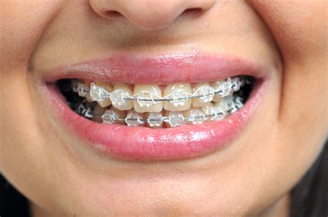 Braces Brackets Chesspoliz