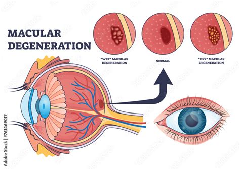Macular Degeneration As Eye Illness And Eyesight Problem Outline