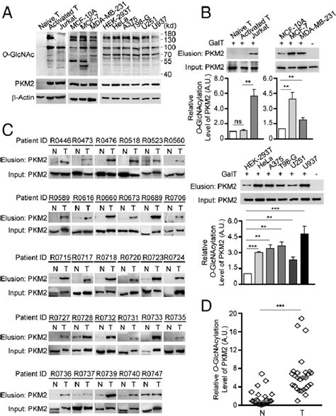 Pkm2 Is Highly O Glcnacylated In Tumor Cells And Patient Tumor Tissues