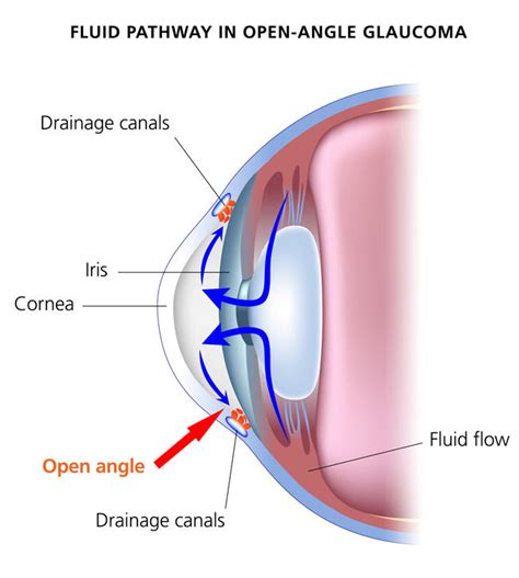 Closed Angle Glaucoma Vs Open Angle