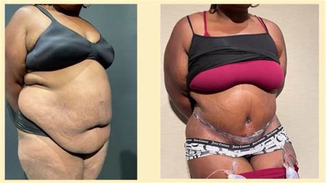 The Fleur De Lis Tummy Tuck Sculpting A Beautiful Midsection