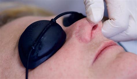Nasal Telangiectasia Treatment Adelaide Acm Laser Clinic