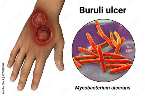 Buruli Ulcer On An Arm 3d Illustration The Disease Caused By