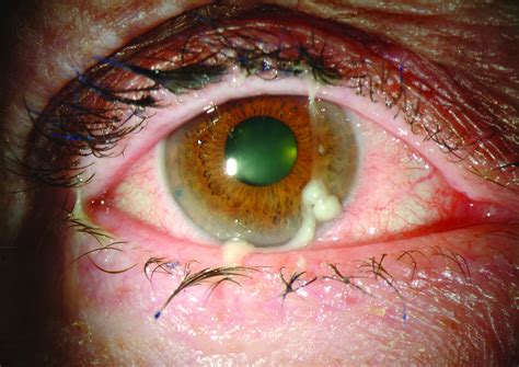 Breach At The Surface Recognizing Threats Behind The Red Eye