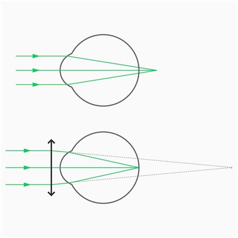 Premium Vector Hyperopia Hypermetropia Farsightedness And