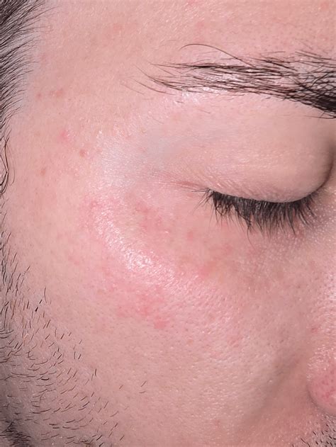 Periocular Dermatitis
