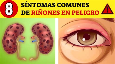 Detecta A TIEMPO unos RIÑONES EN PELIGRO Advertencia Síntomas
