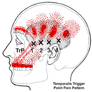 Relieve Headaches Fast With These Trigger Points