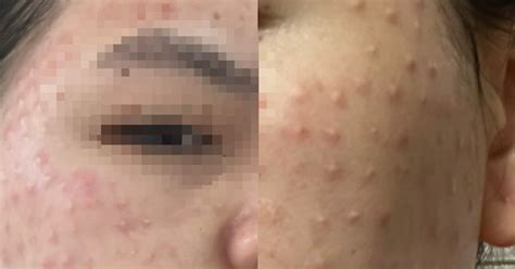 Mặt Chi Chít U Hạt Sau Buổi Tiêm Làm đẹp Da Miễn Phí