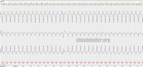Closed Loop Stimulation Cls Marcapasso Biotronik Tme