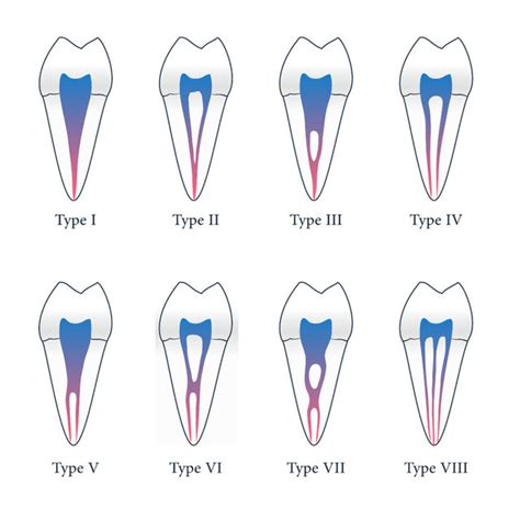 Representation Of Vertuccis Root Canal System Classification Download Scientific Diagram