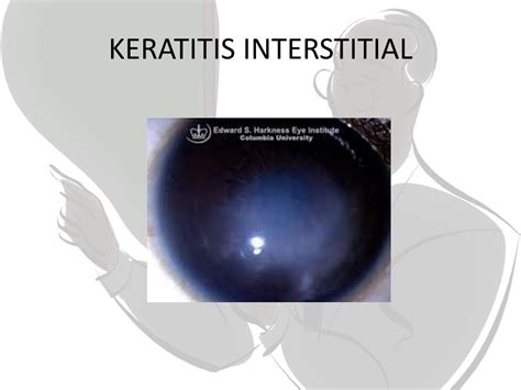 PPT Keratitis PowerPoint Presentation Free Download ID 7377600