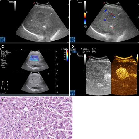 Ultrasonographic And Pathological Features Of Hepatocellular Adenoma Download Scientific