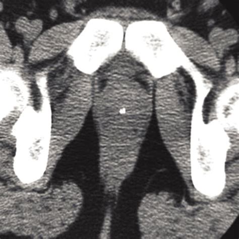 Pelvic Hrct Calcification In The Prostate Hrct High Resolution