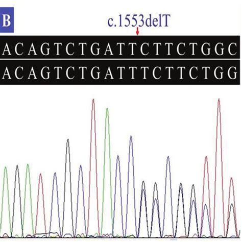 Sequence Analysis Of The Pf518sfs4 Mutation In The Phex Gene Dna