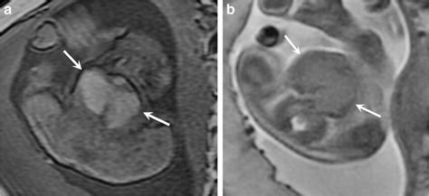An Oval Congenital Granular Cell Tumor Protrudes From The Anterior