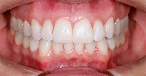 Orthodontist Lichfield Fixed Braces Staffordshire