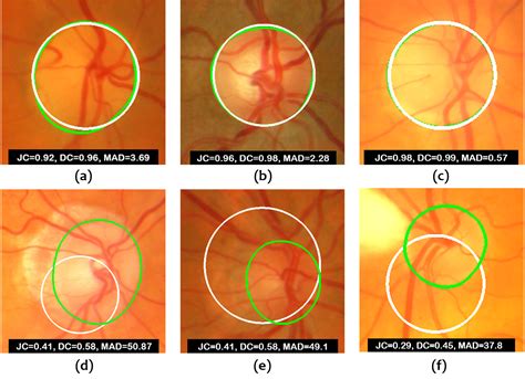 Contrast Based Circular Approximation For Accurate And Robust Optic Disc Segmentation In Retinal