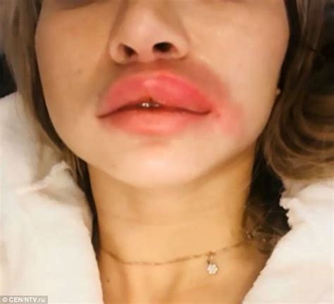 Russian Woman Left Swollen In Hospital After Her Lips Burst Daily