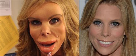 What To Do When Botox Goes Wrong