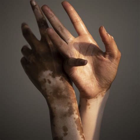 This Photographer Is Shooting Almost 100 People With Vitiligo Artofit
