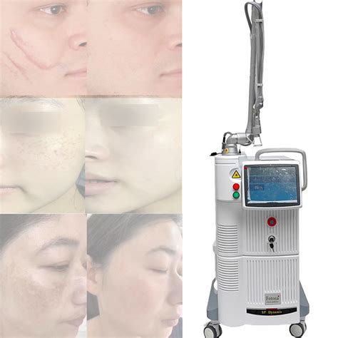 Máquina de Belleza Láser Fotona D para el Rejuvenecimiento Facial