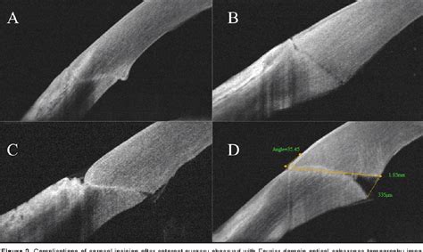 Figure 2 From Architectural Analysis Of Clear Corneal Incision