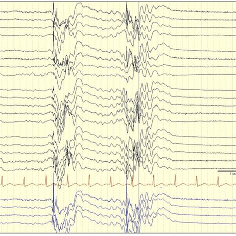 Continuous Electroencephalographic Eeg Monitoring Is An Effective