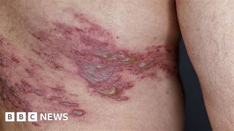 Shingles Vaccine Extended To Vulnerable Over 50s Bbc News