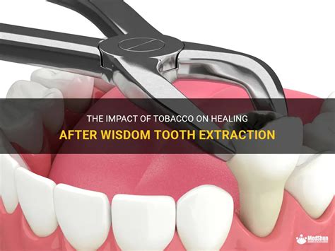 The Impact Of Tobacco On Healing After Wisdom Tooth Extraction Medshun