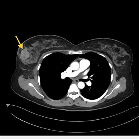 Small Lump In Chest Area At Stella Prell Blog