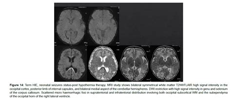 Journal Of Radiology Hypoxic Ischemic Encephalopathy Mri Findings And