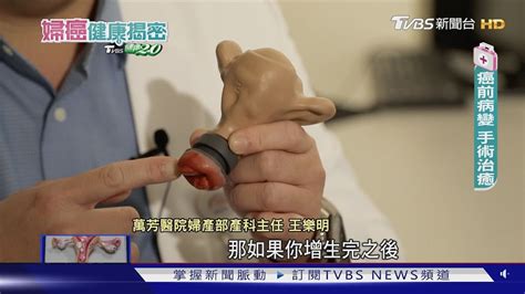 抹片檢查仍有偽陰性 防子宮頸癌可加做「這個」敏感度更高│婦癌健康揭密 Youtube