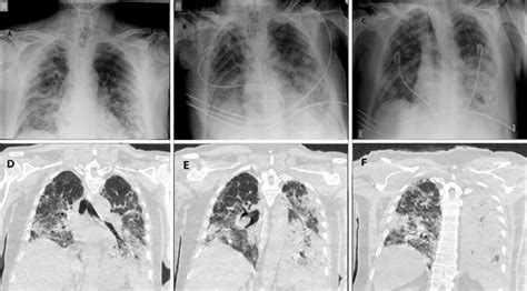 A Mobile Chest Radiograph Day 0 Demonstrates Diffuse Reticular Download Scientific Diagram