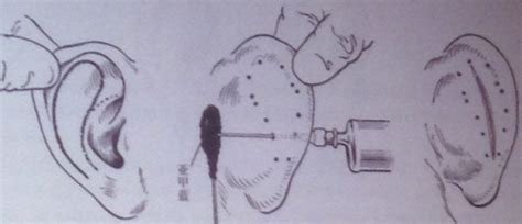 耳前瘘管切除术 哔哩哔哩