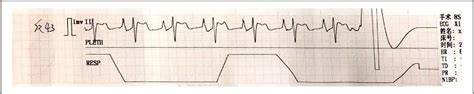 Figure 3 From An Ecg Method For Positioning The Tip Of A Picc In “mirror People” With