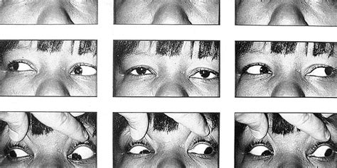 Abnormal Eye Movements Not Essential Feature Of Peduncular Hallucinosis