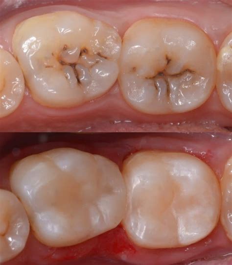 A Recipe For Class Ii Composite Restoration Myzerodonto