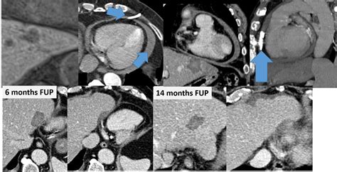 Rosario Francesco Grasso On Linkedin Ir Interventionalradiology Handlingcomplication Ablation