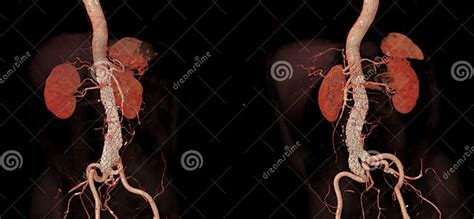 Cta Whole Aorta With Abdominal Aorta Stent Graft Compare 3d Rendering