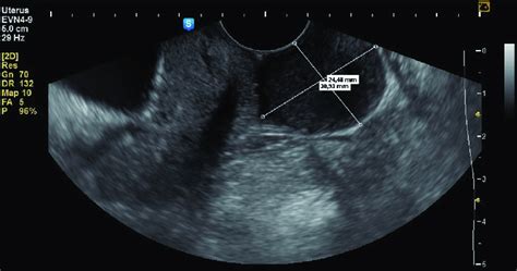 Transvaginal Ultrasound Imaging Sagittal View Of A Mass On The Download Scientific Diagram