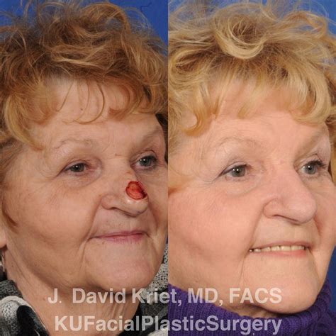 🛑🤚🏼graphic Content In The Following Photos Patient With Nasal Defect