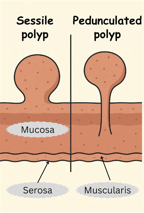 Sessile Vs Pedunculated Colon Polyps A Simple Guide For Students