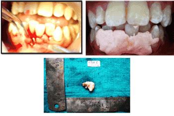 Peripheral Ossifying Fibroma Review And Case Report